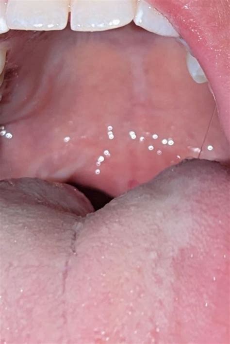 Are These Bruises Signs Of Oral Sex Or Something Else Just Noticed Them Today R Askdentists