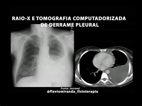 Raio X De Derrame Pleural Actualización Del Derrame Pleural