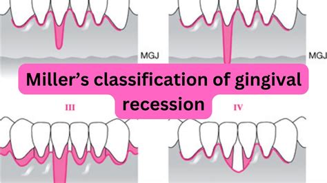 Classification Des Récessions Gingivales