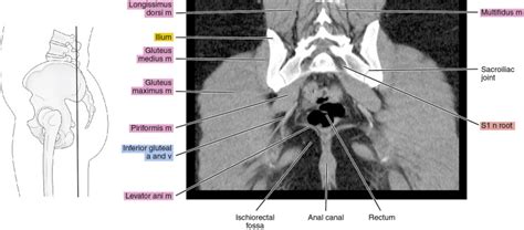 Ct Of The Male Pelvis Radiology Key