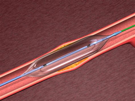 Peripheral Vascular Market Drug Coated Balloons Market Growth In 2021