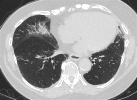 198lu Scleroderma Early Nsip Mild Over 3 Years Lungs