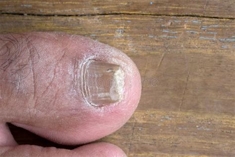 Big Toe Nails Are Fungal Disease Stock Photo Image Of Adult Foot 255643052