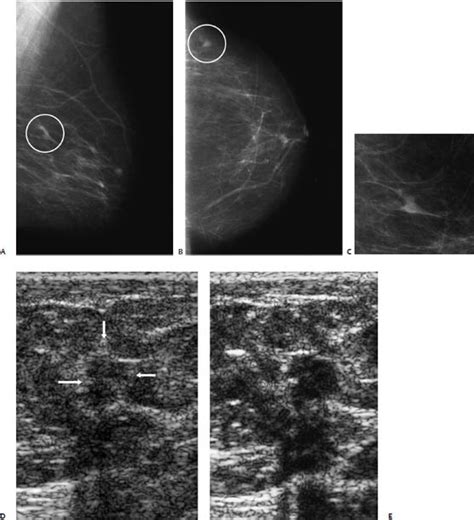 sonographic technique and cross correlation with mammography