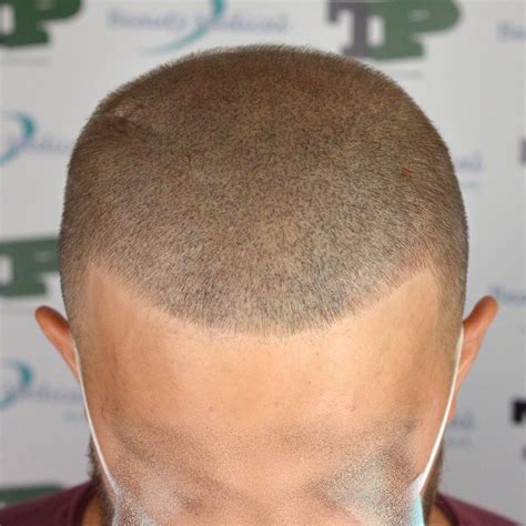 Case 123 Treatment Of Craniotomy Scar And 3 Upper Areas