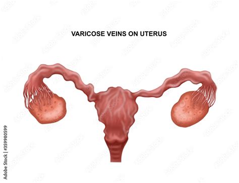 Medical illustration of the varicose veins on uterus ilustração do Stock Adobe Stock