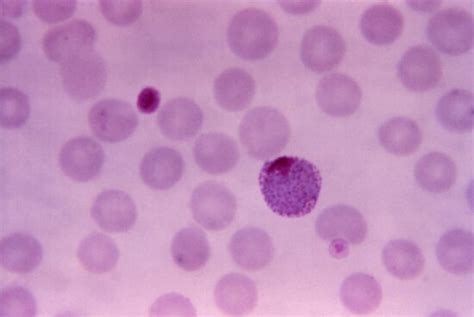 Free Picture Thin Film Micrograph Plasmodium Vivax Ring Form