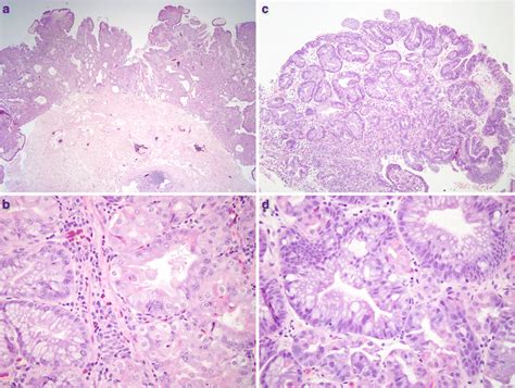 Gastric Adenoma With High Grade Dysplasia In Patient 4 A This Large