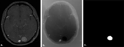 Automated Tumor Volumetry Using Computer Aided Image Segmentation Academic Radiology