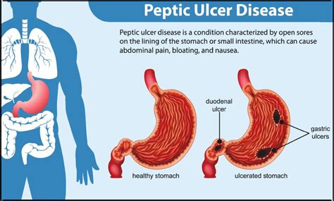 Peptic Ulcers Symptoms Causes Risk Factors And Preven