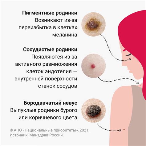 Как правильно самодиагностировать родинки Пациентам