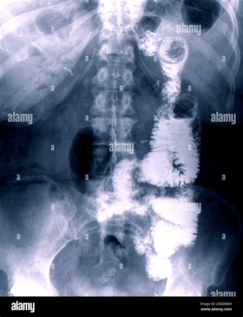 Gastric Bypass Frontal X Ray Of The Digestive System Of An Obese 52