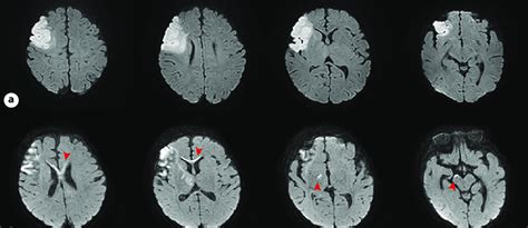 A Right Mca Territory Infarction Was Seen B Newly Appeared Diffusion