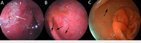 Endoscopy A Terminal Ileum No Visible Villi Erythematous Mucosa Or Download Scientific