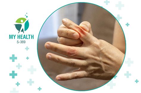 Uric Acid Variations Learn How To Maintain Healthy Levels