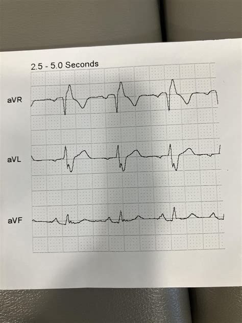 36yom Cc Intermittent L Sided Chest Pain 510 Radiating Left Arm Hx
