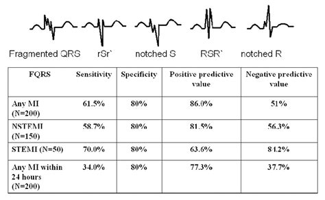 Acute Myocardial Infarction On ECG ECG Disease Patterns
