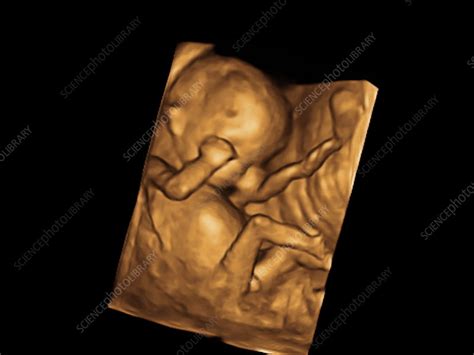 Foetus Ultrasound Scan Stock Image C034 7077 Science Photo Library