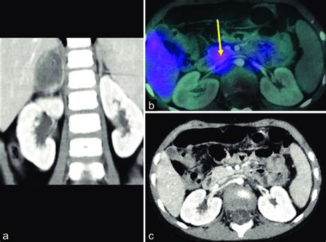 A C 123 I Meta Iodobenzylguanidine Single Photon Emission Download Scientific Diagram