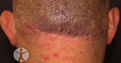 Scalp Folliculitis Image