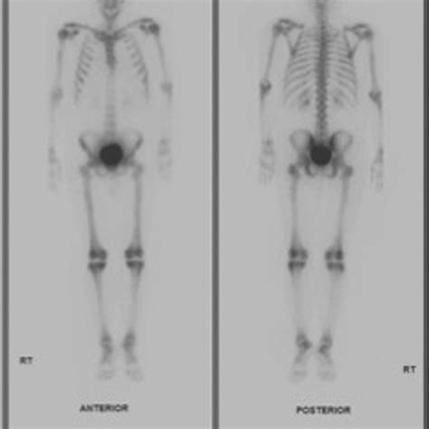 Marrow Infiltrative Process And Diffuse Periostitis On Mr Imaging A