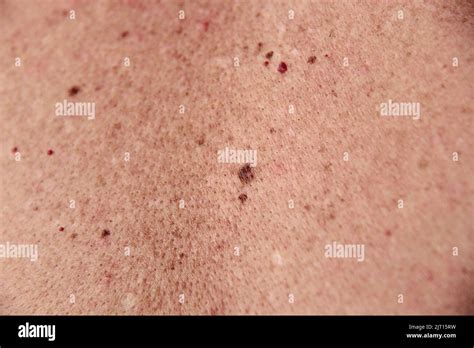 Skin Macro Close Up With Capillaries And Sun Spots Moles Red And
