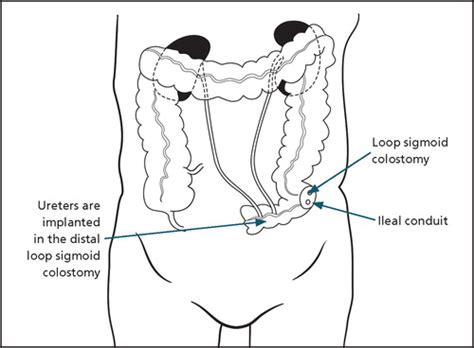 Double Barrelled Uro‐colostomy Versus Ileal Conduit For 57 Off Double Barrelled Uro‐colostomy Versus Ileal Conduit For 57 Off