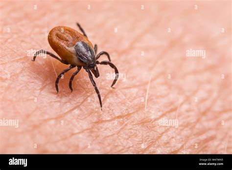 Infected Female Deer Tick On Hairy Human Skin Ixodes Ricinus