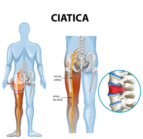 Tengo ciática y no puedo andar qué hacer