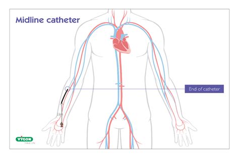 The Varying Terminology Surrounding Midline Catheters Vascufirst