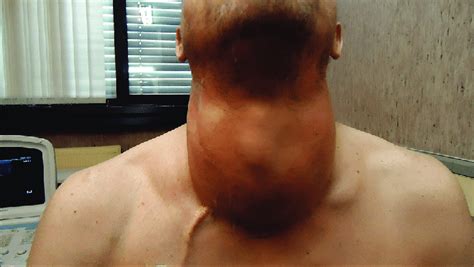 Diffusely Enlarged Thyroid Gland Download Scientific Diagram