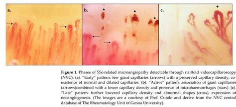 Phases Of Ssc Related Microangiopathy Download Scientific Diagram