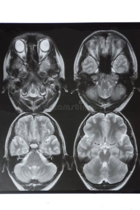 Macrophoto Of Computer Tomography With The Brain Medical Scientific