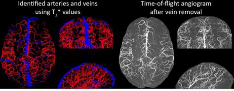 Removal Of Non Arterial Vessels In Time Of Flight Imaging LEFT