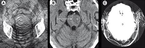 Understanding Ct Artifacts A Comprehensive Guide