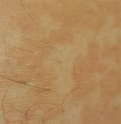Plamy Na Ciele ForumDermatologiczne Pl