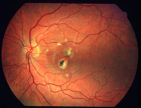 Punctate Inner Choroidopathy Pic Retina Image Bank