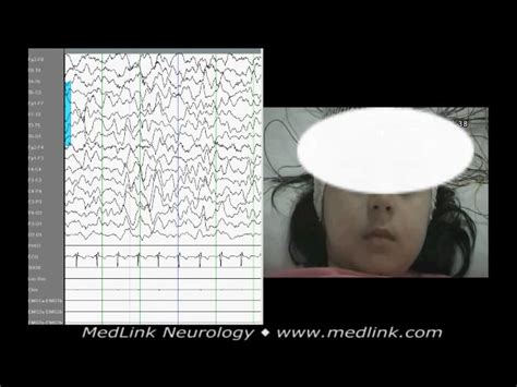 Self Limited Epilepsy With Autonomic Seizures Medlink Neurology