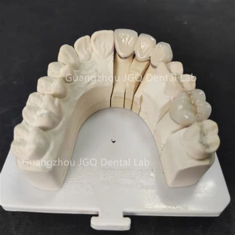 Natural Appearance 3d Printing Pfm Co Cr Alloy 3 Unit Bridge Metal