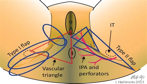 The Internal Pudendal Artery Perforator Flap Free Style Ped