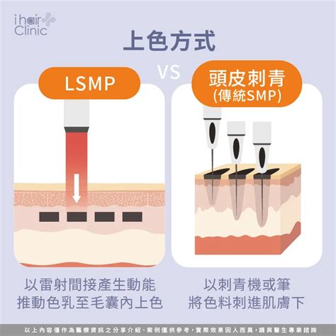 Lsmp是刺青嗎4個lsmp頭皮紋繡與刺青的差異告訴你 Ihair風華御髮