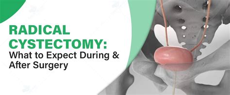 Radical Cystectomy Surgery What To Expect During And After Surgery