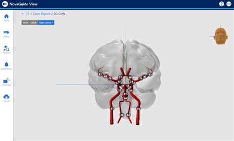 How To Read A Tcd Report Even If Youre Not A Neurologist