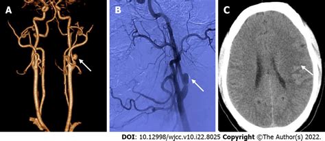 Left Internal Carotid Artery Pseudoaneurysm With Acute Ischemic Stroke Download Scientific