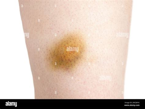 Close Up Of Bruise Of Hitting In The Leg Of Woman On White Background
