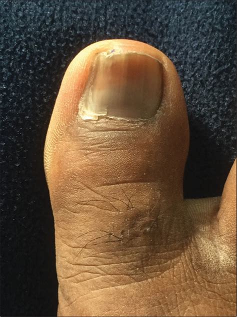A Customized Syringe For Separating Ingrown Toe Nail From The Gutter Jcas
