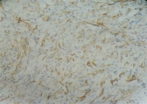 Spindle Cells Arranged As Bundles And Fascicles Admixed With