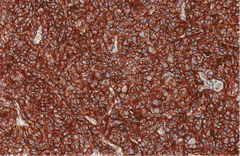 Tumour Showed Diffuse Membranous Positivity For Cd99 Download