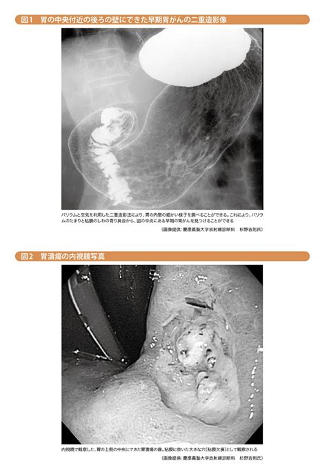 胃十二指腸の病気を診断するX線検査と内視鏡検査