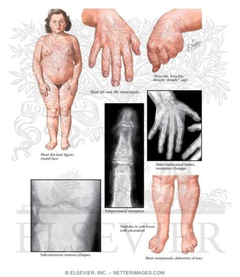 Pseudohypoparathyroidism Pathophysiology